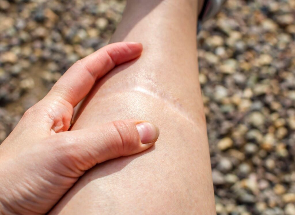 Scar Tissue Therapy in Honolulu: Heal & Move Better